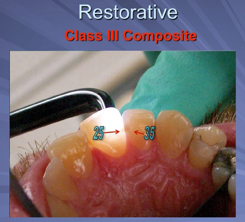 Restorative Dentistry | Lasers in Dentistry: Minimally Invasive ...