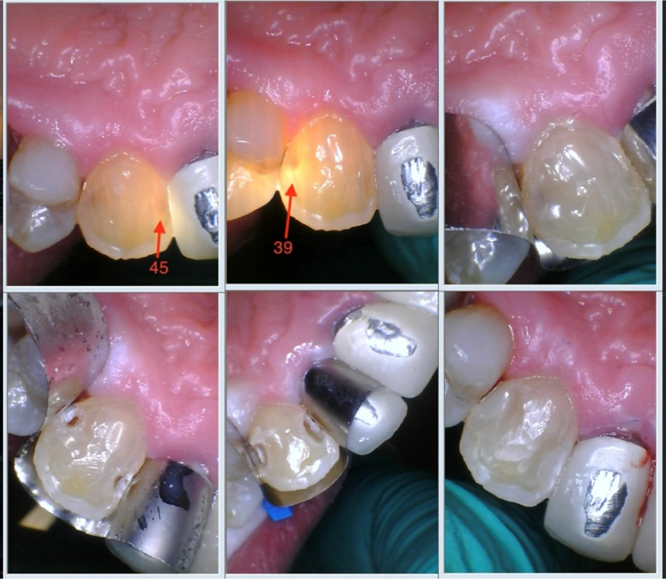 Restorative Dentistry | Lasers in Dentistry: Minimally Invasive ...