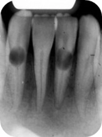 Resorptive Processes - Anomalies of Tooth Structure - Dentalcare