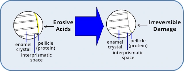 Fluoride and Erosive Tooth Wear - Managing Dental Erosion: Current ...