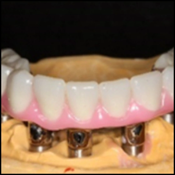 Full Arch Implant Prostheses: Part II - Fabrication Procedures ...