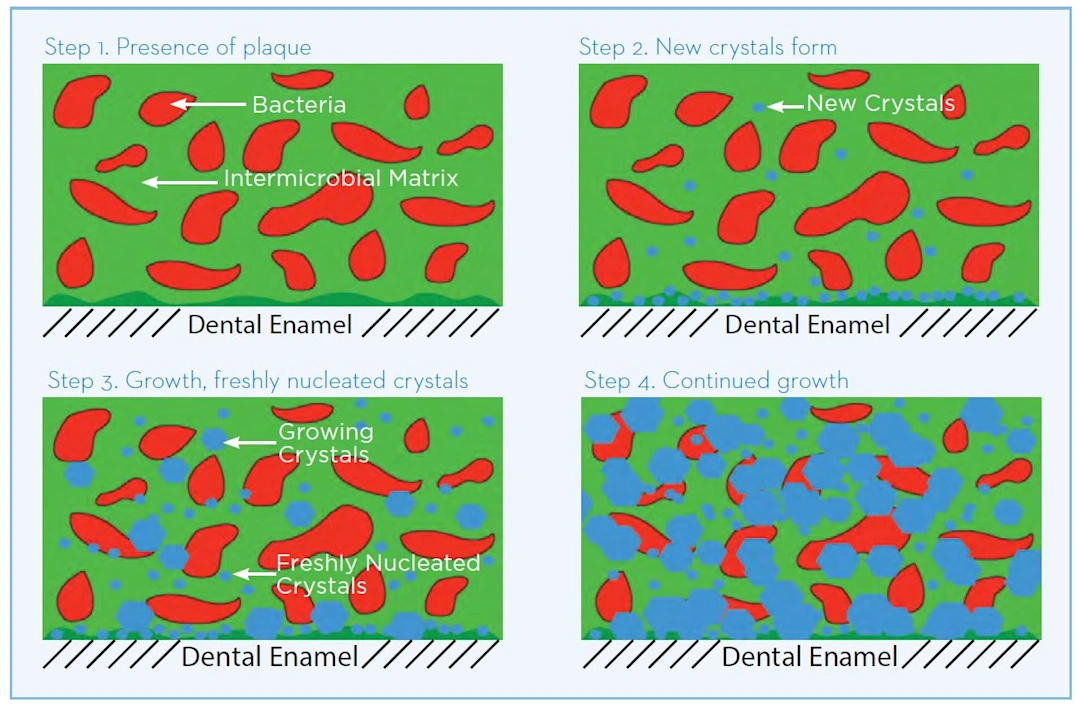 Dental Calculus Treatment - Stannous Fluoride Toothpaste | Dentalcare