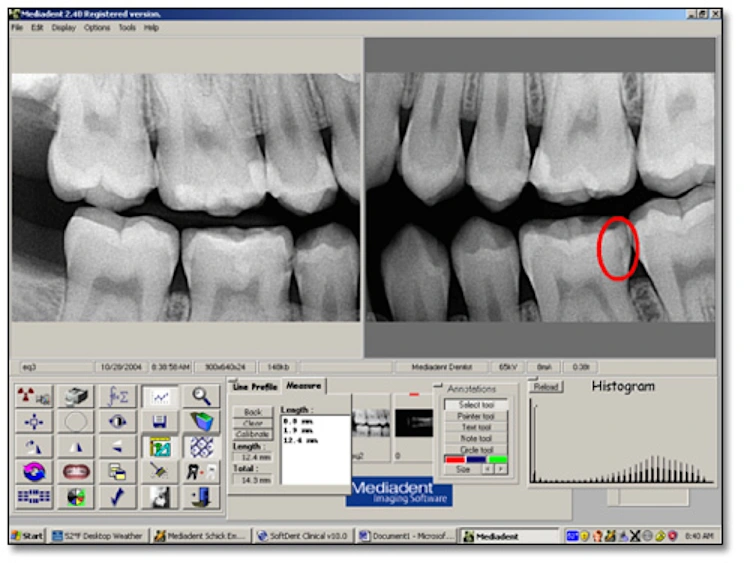 Digital Radiography - An Update on Demineralization/Remineralization ...