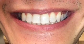 Terms A-C - Oral Health Care: A Whole New Language - Dentalcare