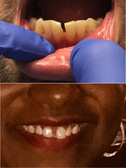 Terms D-L - Oral Health Care: A Whole New Language - Dentalcare