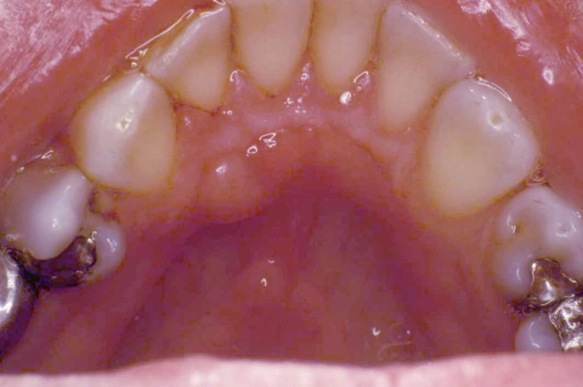 Diagnostic Information | Incidental Bump on Lingual Gingiva ...