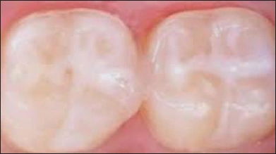 Cavity Prevention - Professional Dental Terminology for the Dental ...