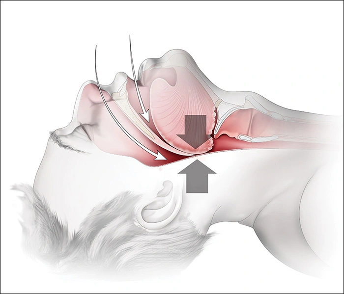 Pathophysiology of OSA - Sleep Apnea Management for the Dentist ...