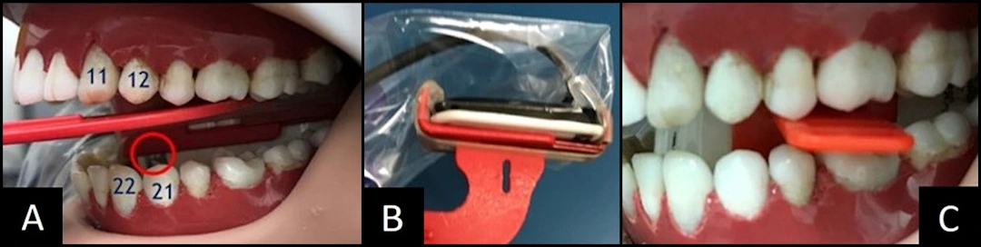 Problem #3: Fail to Capture Distal of Canine on Premolar Bitewing Image | Intraoral Imaging ...