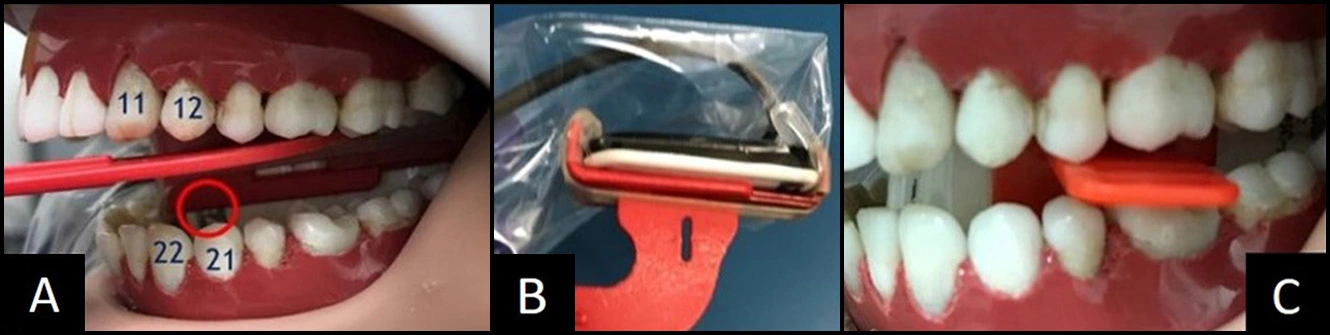 Problem #3: Fail to Capture Distal of Canine on Premolar Bitewing Image ...