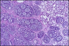 Diagnostic Information | Mass in the Upper Lip | dentalcare.com