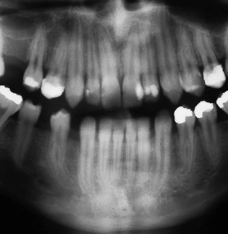 Supernumerary Roots - Anomalies of Tooth Structure - Dentalcare