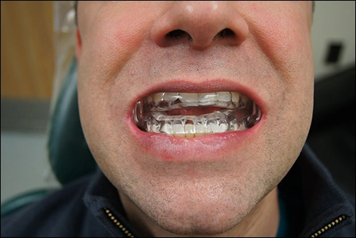 Delivery of the MAD - Sleep Apnea Management for the Dentist - Dentalcare