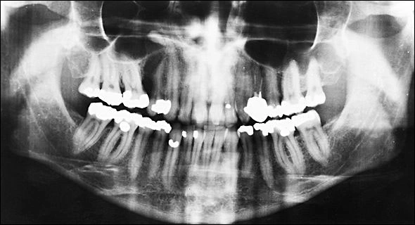 Diagnostic Information | Chronic Inflammation on the Right Side of the ...