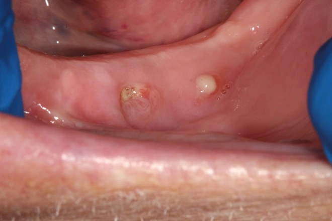 Select Diagnosis | Painful Ulcerations 9 Months After Immediate Denture ...