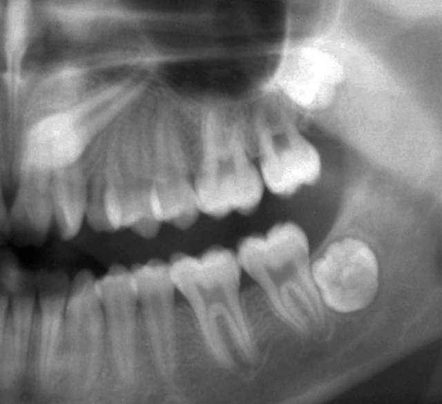 Delayed Eruption - Anomalies of Tooth Structure - Dentalcare
