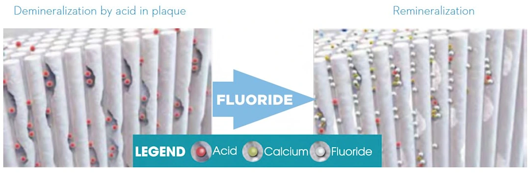 Dental Caries Treatment - Stannous Fluoride Toothpaste | Dentalcare