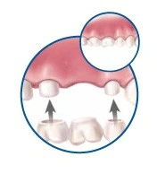 Restorative Dentistry - Tooth Restoration Techniques | Dentalcare