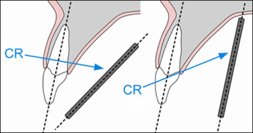 Technique Errors - Intraoral Imaging: Basic Principles, Techniques and ...