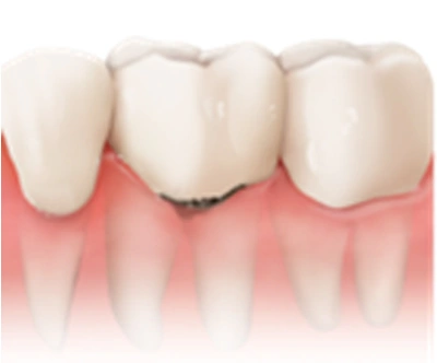 Carious Lesions - Professional Dental Terminology for the Dental ...