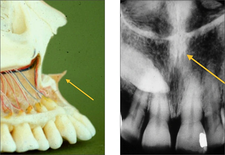 Maxillary Anterior Landmarks - Intraoral Radiographic Anatomy - Dentalcare