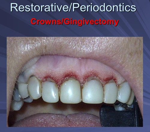 Gingivectomy | Lasers in Dentistry: Minimally Invasive Instruments for ...