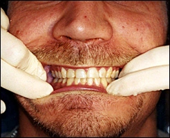 Oral Manifestations of Methamphetamine Abuse | Methamphetamine ...