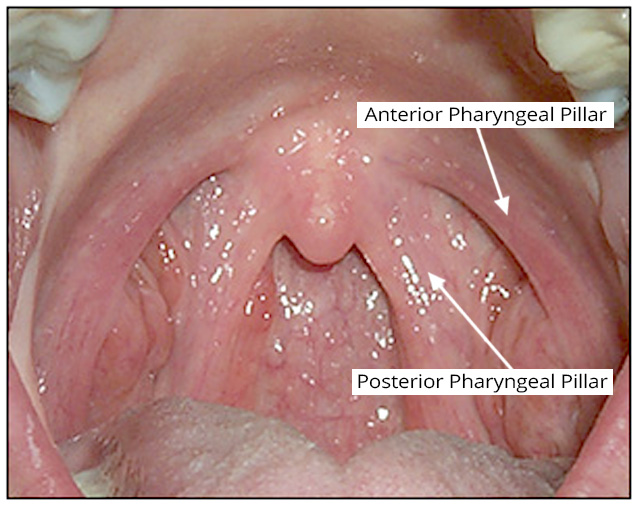 tonsillar arch