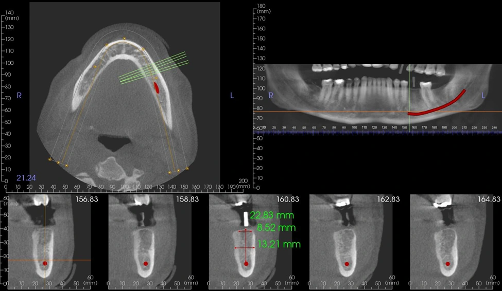 Implant Dentistry - Cone-Beam Computed Tomography (CBCT) Applications ...