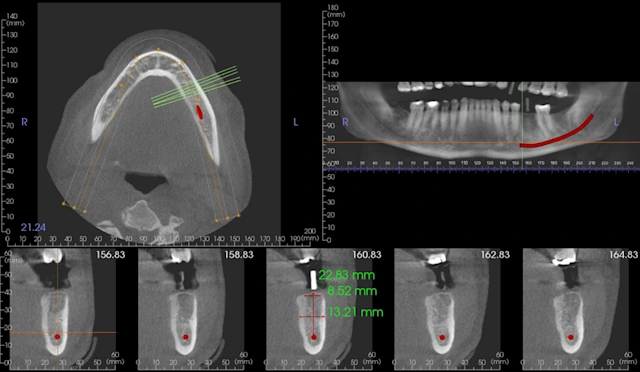 Implant Dentistry - Cone-Beam Computed Tomography (CBCT) Applications ...