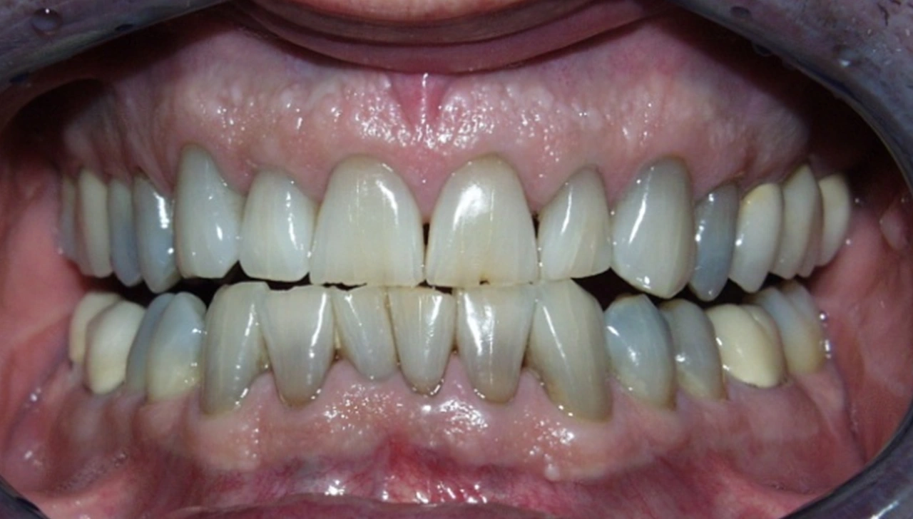 Chromogens On and In Teeth – Definitions and Origins | How Whitening ...