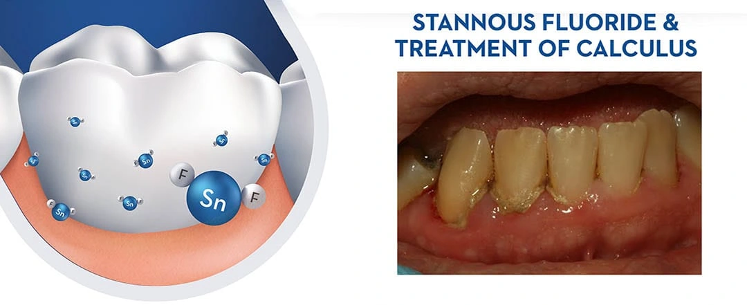 Dental Calculus Treatment - Stannous Fluoride Toothpaste | Dentalcare