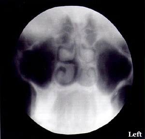Diagnostic Information | The Case of the Missing Root Tip | DentalCare.com