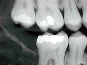 Diagnostic Information | The Case of the Post-Extraction Bone Lesion ...