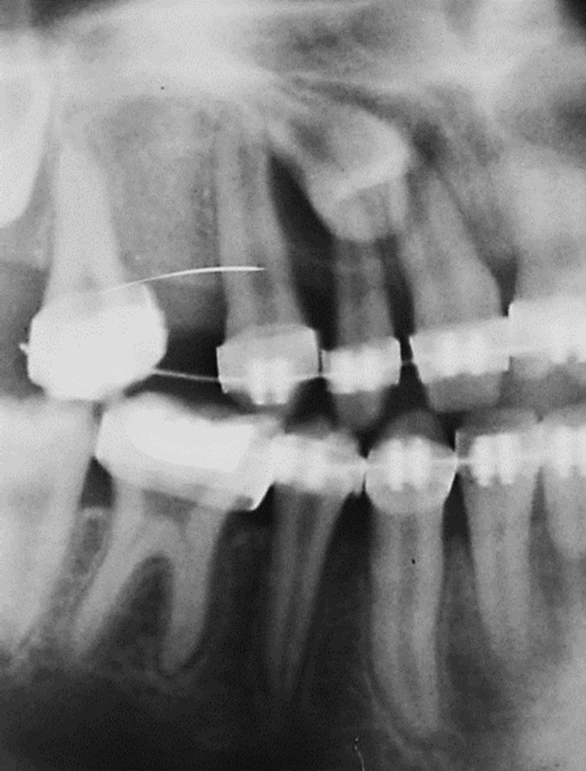 Transposition - Anomalies of Tooth Structure - Dentalcare