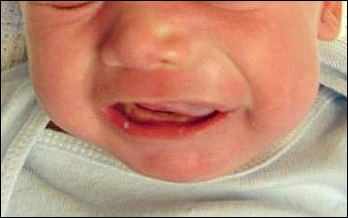 Select Diagnosis | Maxillary Swelling in an Infant Selectdiagonosis ...