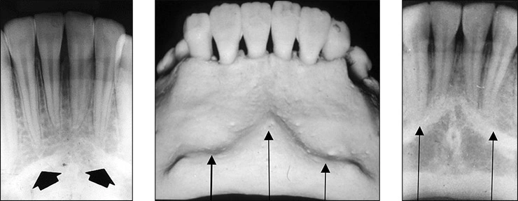 Mandibular Anterior Landmarks - Intraoral Radiographic Anatomy - Dentalcare