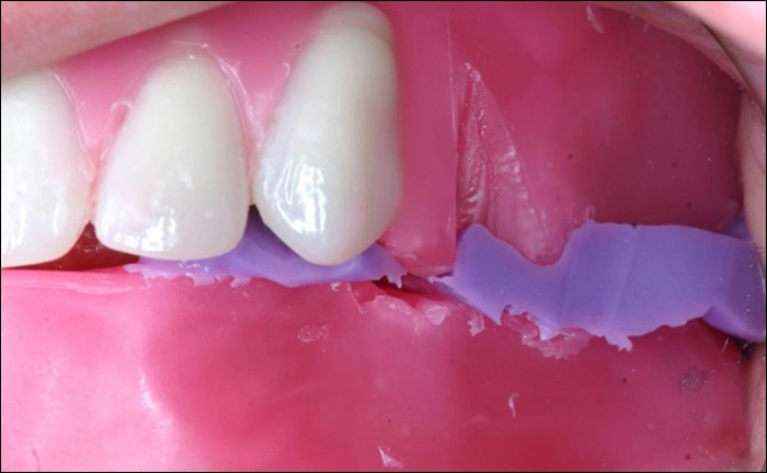 Third Clinical Appointment - Full Arch Implant Prostheses: Part II ...