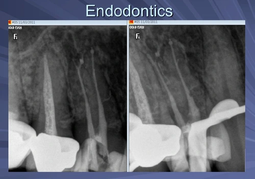 Endodontic Applications | Lasers in Dentistry: Minimally Invasive ...
