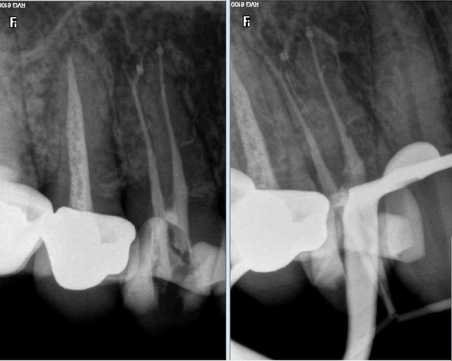 Endodontic Applications | Lasers in Dentistry: Minimally Invasive ...