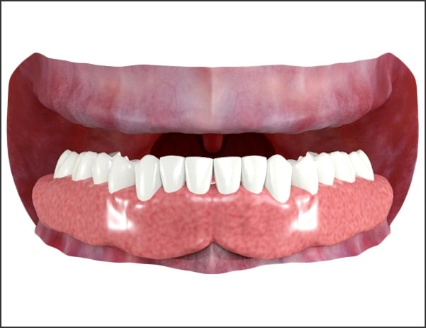 Appropriate Application of Denture Adhesive | Prosthesis Retention and ...