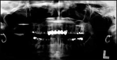 Features of an Optimal Panoramic Radiograph - Practical Panoramic ...