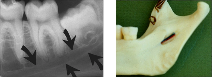Mandibular Posterior Landmarks - Intraoral Radiographic Anatomy ...