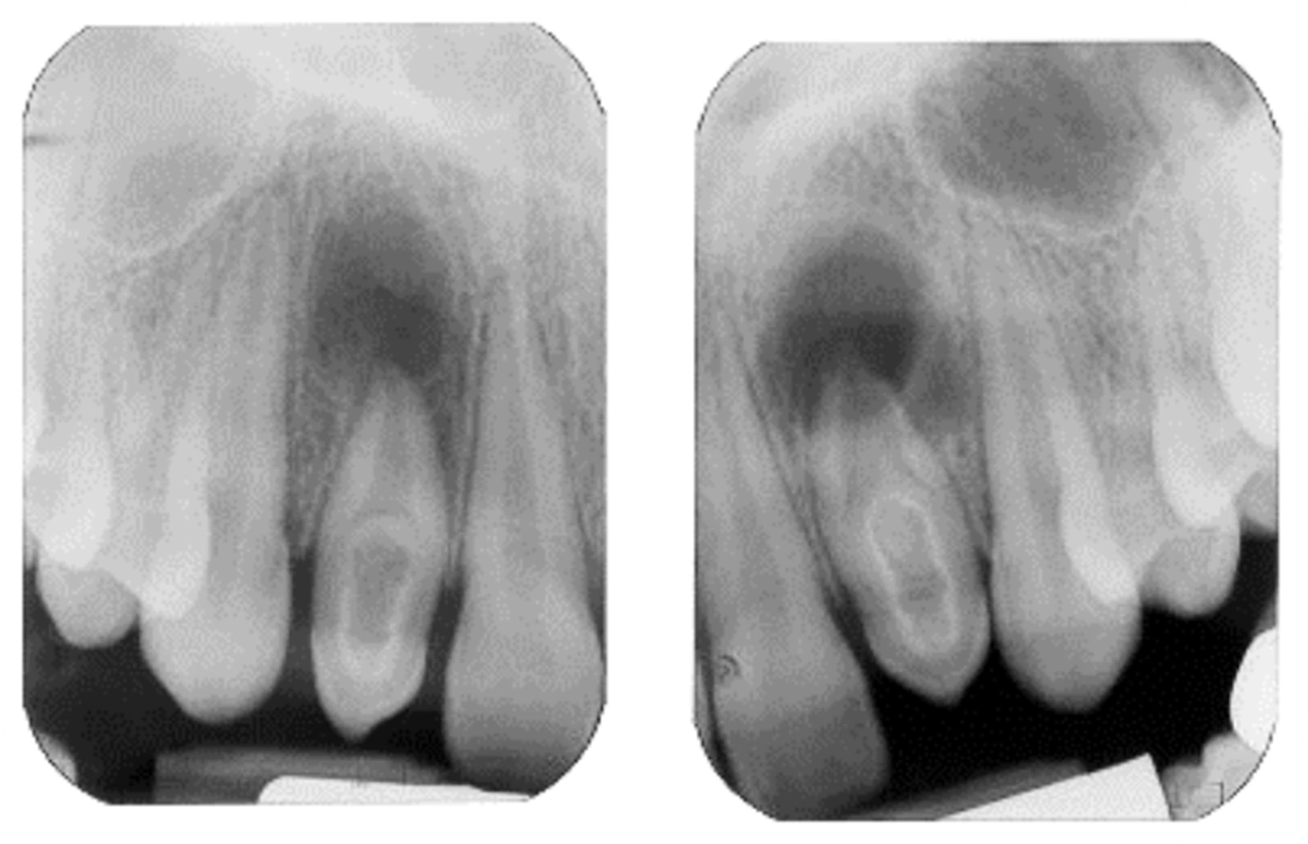 Dens Invaginatus - CE651