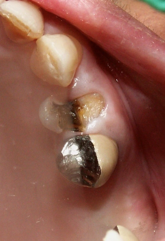 Minimal Flap Crown Lengthening | Lasers in Dentistry: Minimally ...