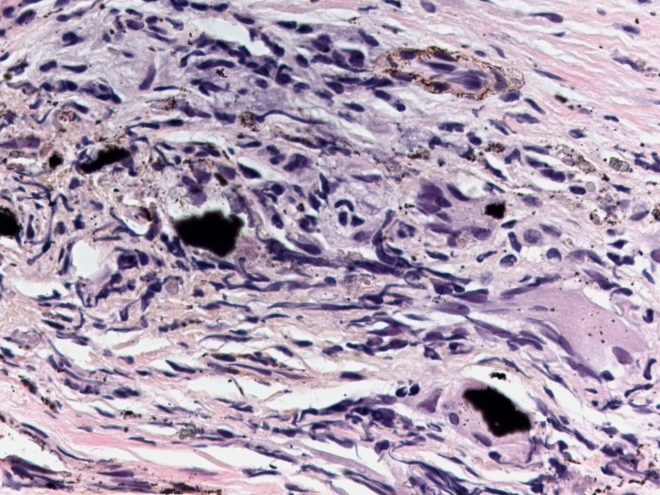 Diagnostic Information | Incidental Blue-Gray Macule on Palate ...