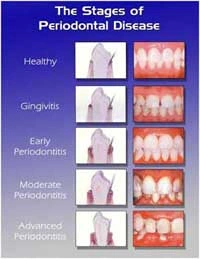 何为牙龈炎？- What is Gingivitis? - Chinese | Dentalcare