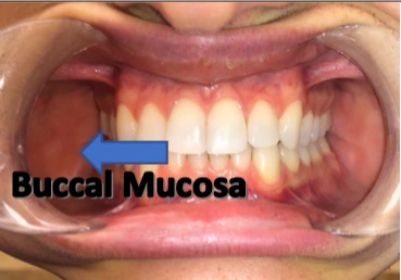 Terms A-C - Oral Health Care: A Whole New Language - Dentalcare