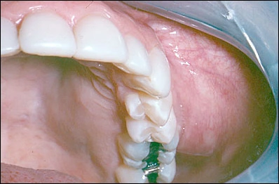 Diagnostic Information | Expansile Mass of the Left Maxilla ...