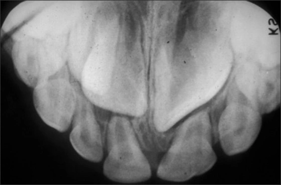 Conjoined Teeth - Anomalies of Tooth Structure - Dentalcare